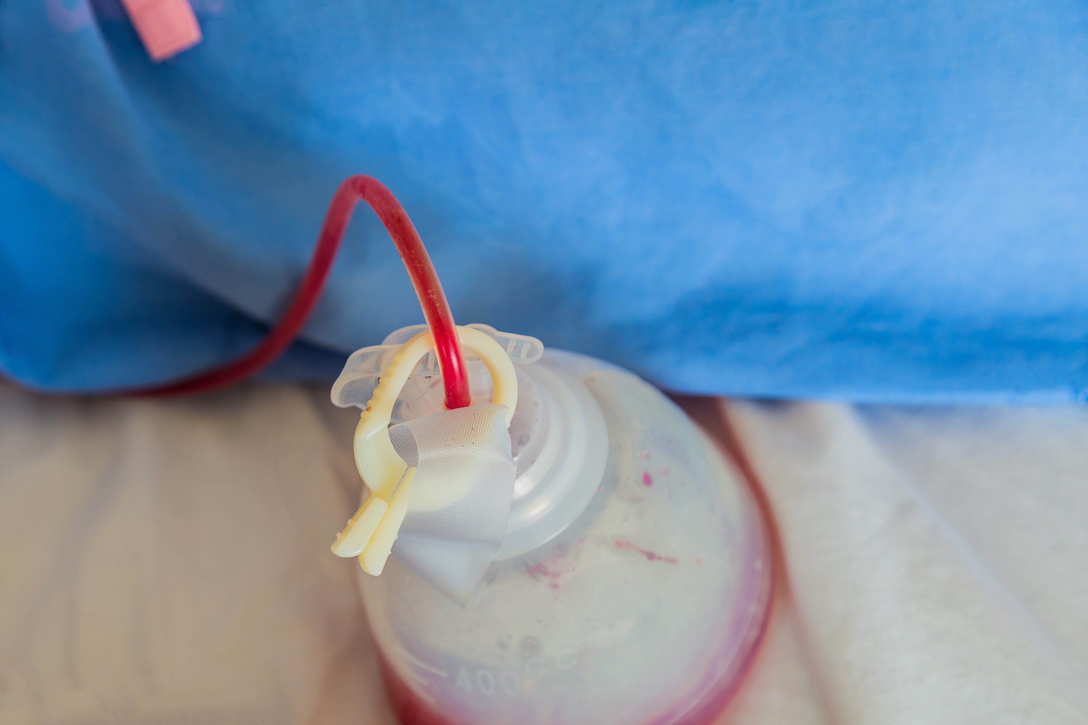 Accurate Measurement of Drain Output Post-Abdominoplasty: A Step-by-St ...